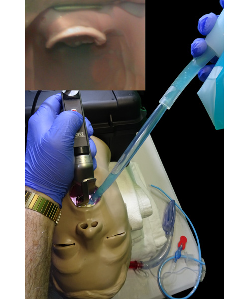 SEADUC™ Suction Easy™ with SSCOR DuCanto Catheter® - EM Innovations ...